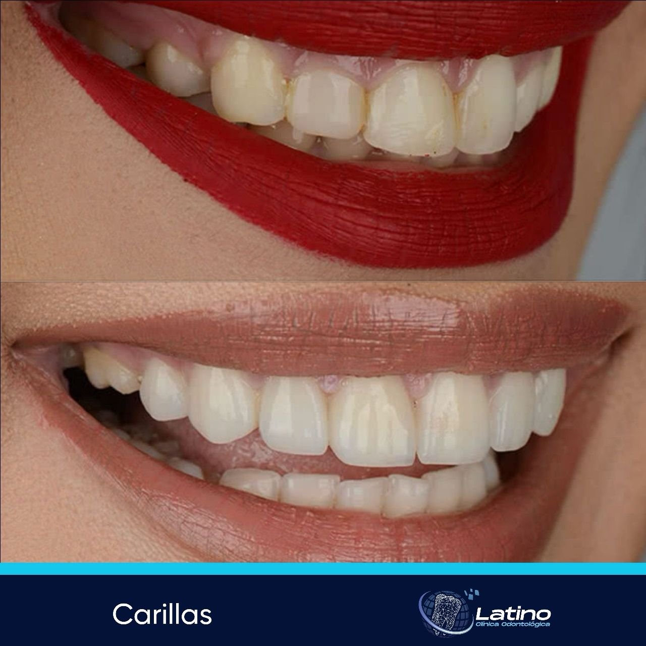 endodoncia en Cuenca – latino – OdontoLab